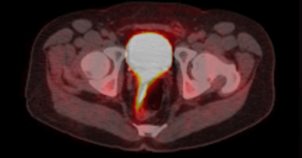 Perirectal Artifact【FDG PET/CT】｜TKG画像診断