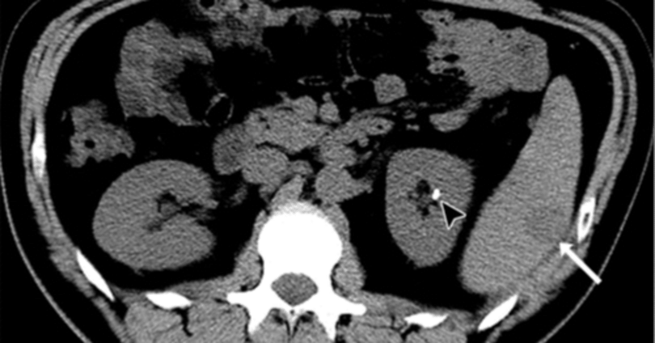 CTで偶発的に発見される脾病変が悪性である頻度は｜TKG画像診断