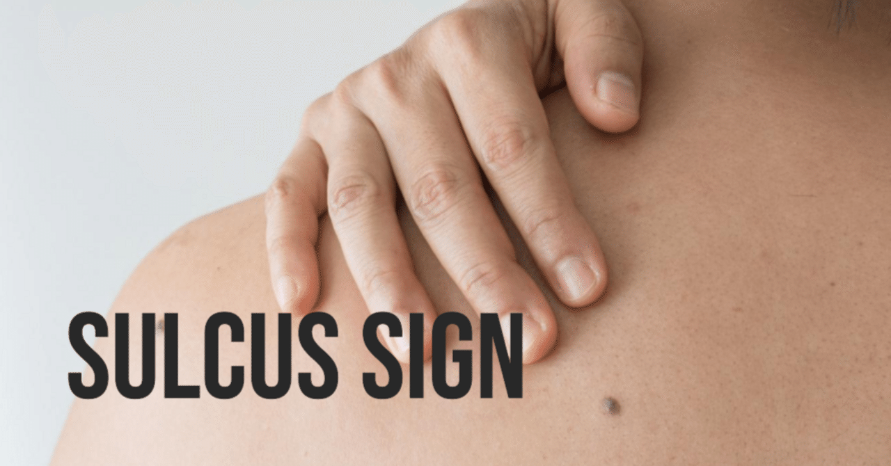 Sulcus Sign：肩関節下方不安定性の有無｜PT Type B