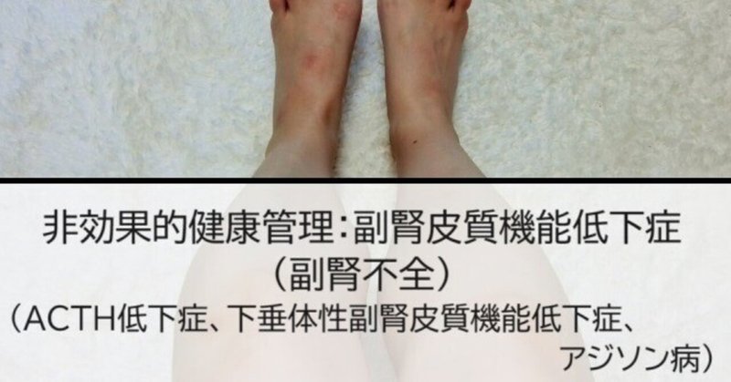 もっと楽々コピペで立案!非効果的健康管理:副腎皮質機能低下症(副腎不全)の看護計画(acth低下症、下垂体性副腎皮質機能低下症、アジソン病