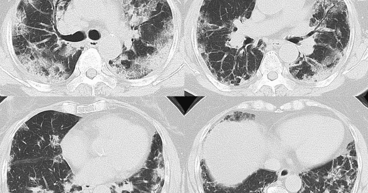抗MDA5抗体陽性急速進行性間質性肺炎｜TKG画像診断