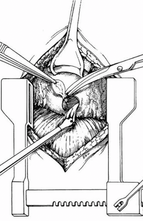 Subxiphoid Pericardial Window｜外傷外科医なおたろう＠3児の父