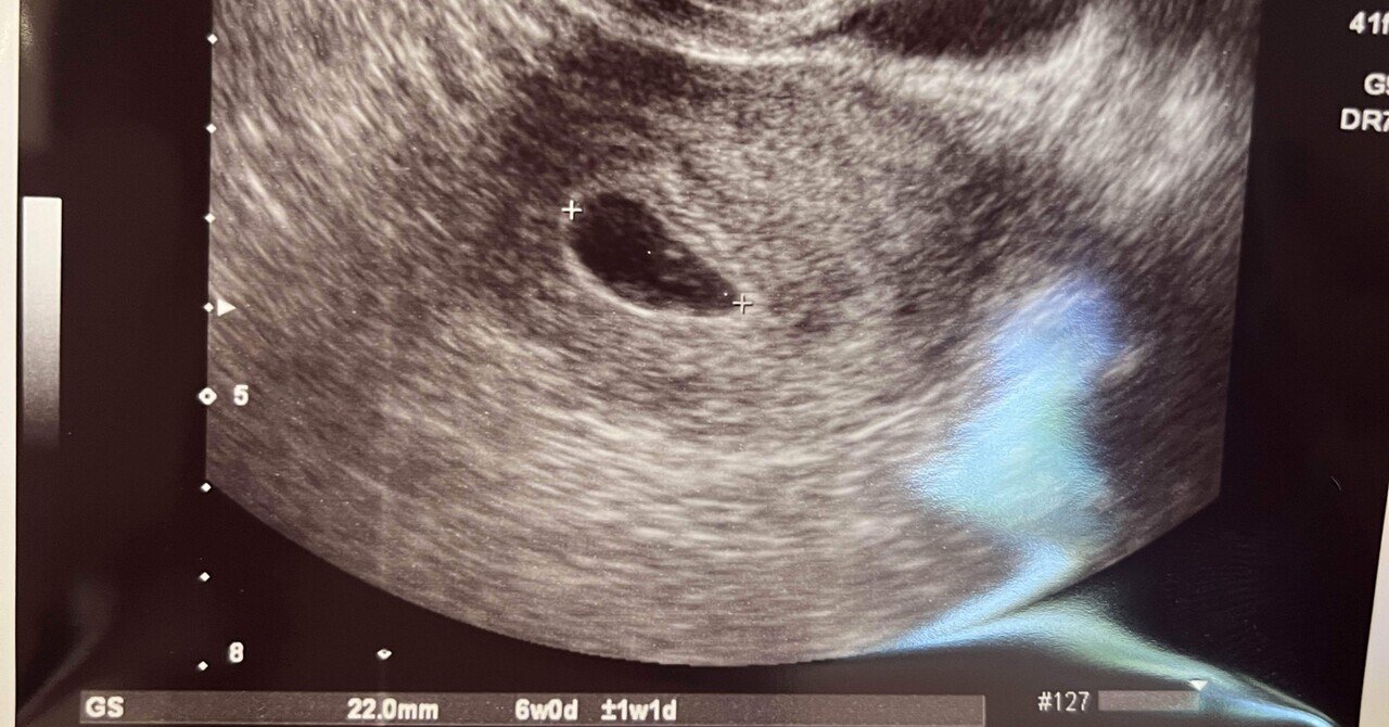 妊娠日記 #2｜みなみ