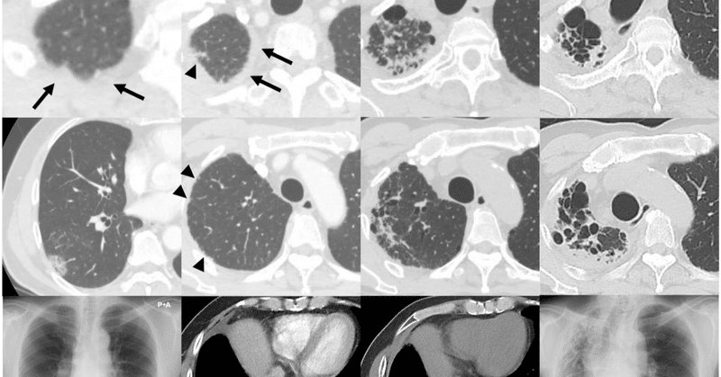 肺癌術後の片側性のPPFE(Pleuroparenchymal fibroelastosis)様変化｜TKG画像診断