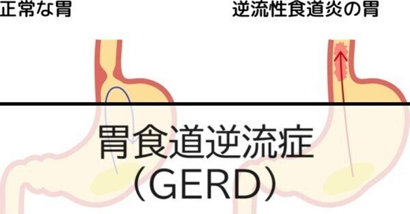 【完全公開はnoteだけ】サクッとまるわかり!胃食道逆流症(gerd)の看護診断|なんでなんだナーシング30 ~看護師・看護学生のための