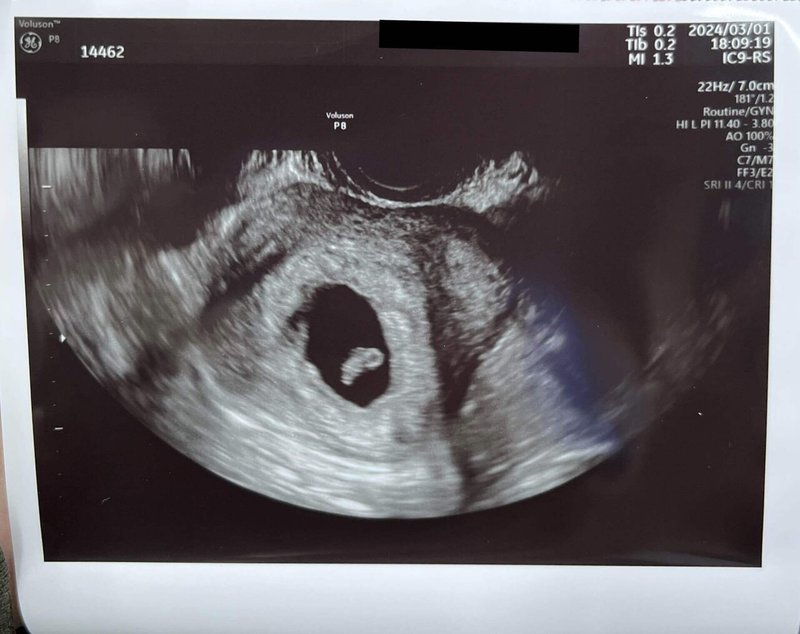 7w0d 検診｜うに 2023年治療再開42歳