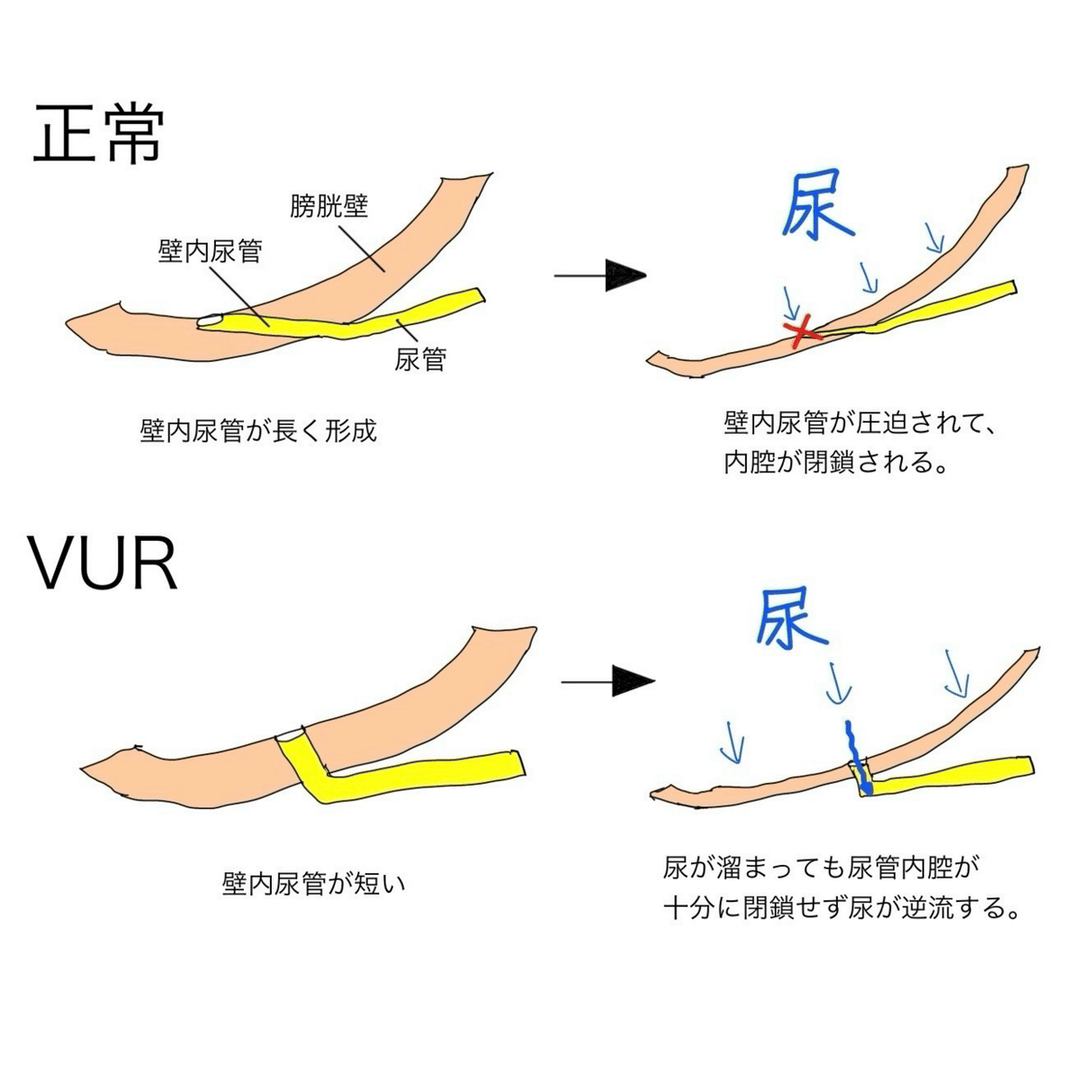 分かりやすい膀胱尿管逆流(VUR)の解説｜かえる/臨床検査技師