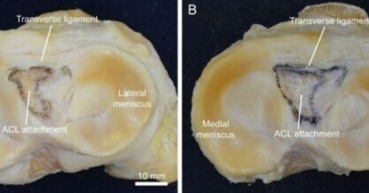 20240404: native ACL・外側半月板前角・解剖・付着形状｜Brain storm conditioning 〜 脳からコンディショニング