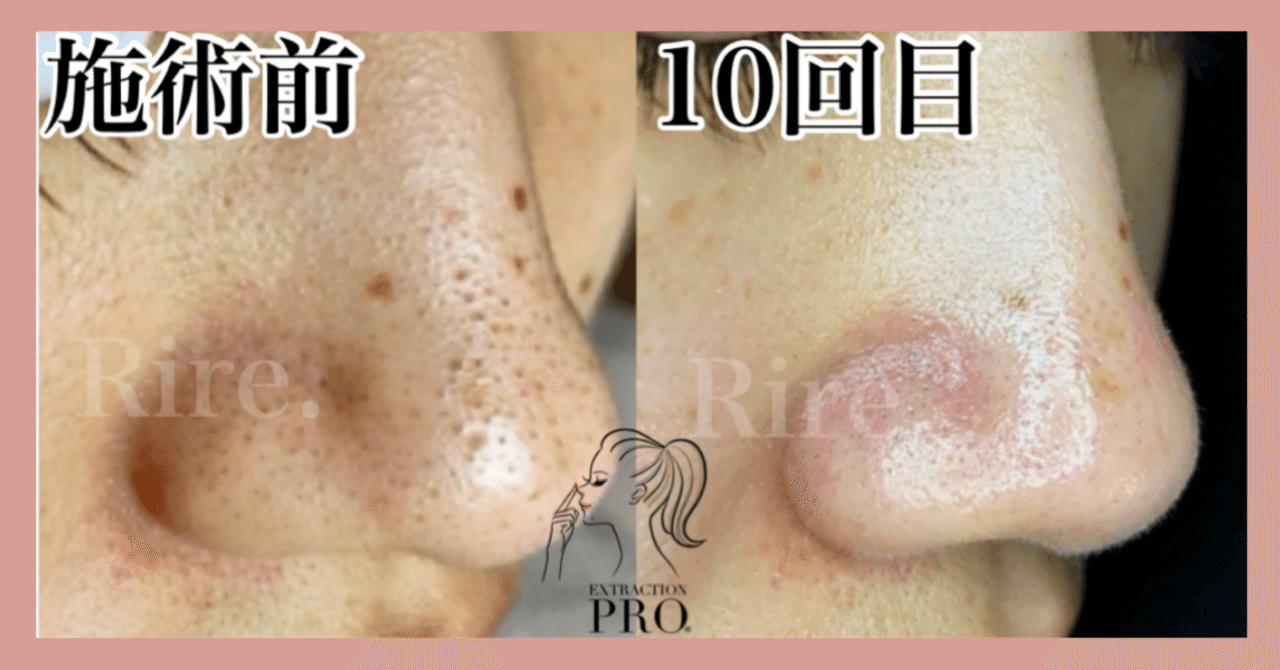 結果重視の毛穴エクストラクションプロとは？｜noriko_rire