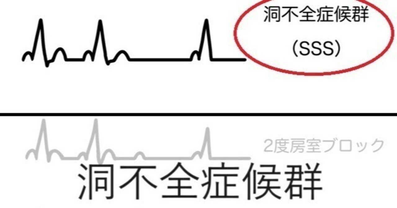 【完全公開はnoteだけ】サクッとまるわかり！洞不全症候群（続発性または症候群性洞不全）の看護診断｜なんでなんだナーシング30 ～看護師