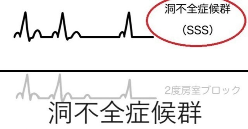 【完全公開はnoteだけ】サクッとまるわかり！洞不全症候群（続発性または症候群性洞不全）の看護診断｜なんでなんだナーシング30 ～看護師