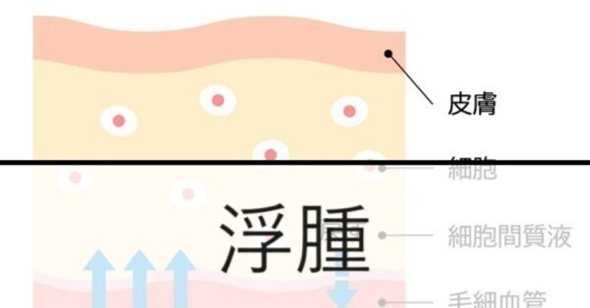 【完全公開はnoteだけ】もっと楽々コピペで立案！浮腫の看護計画｜なんでなんだナーシング30