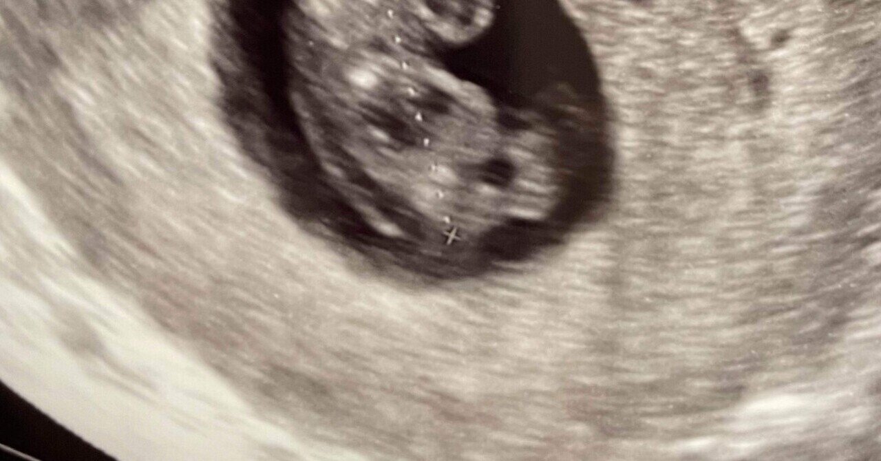 急な出血(鮮血)〜心拍停止(9w5d)｜ぴこ🪽