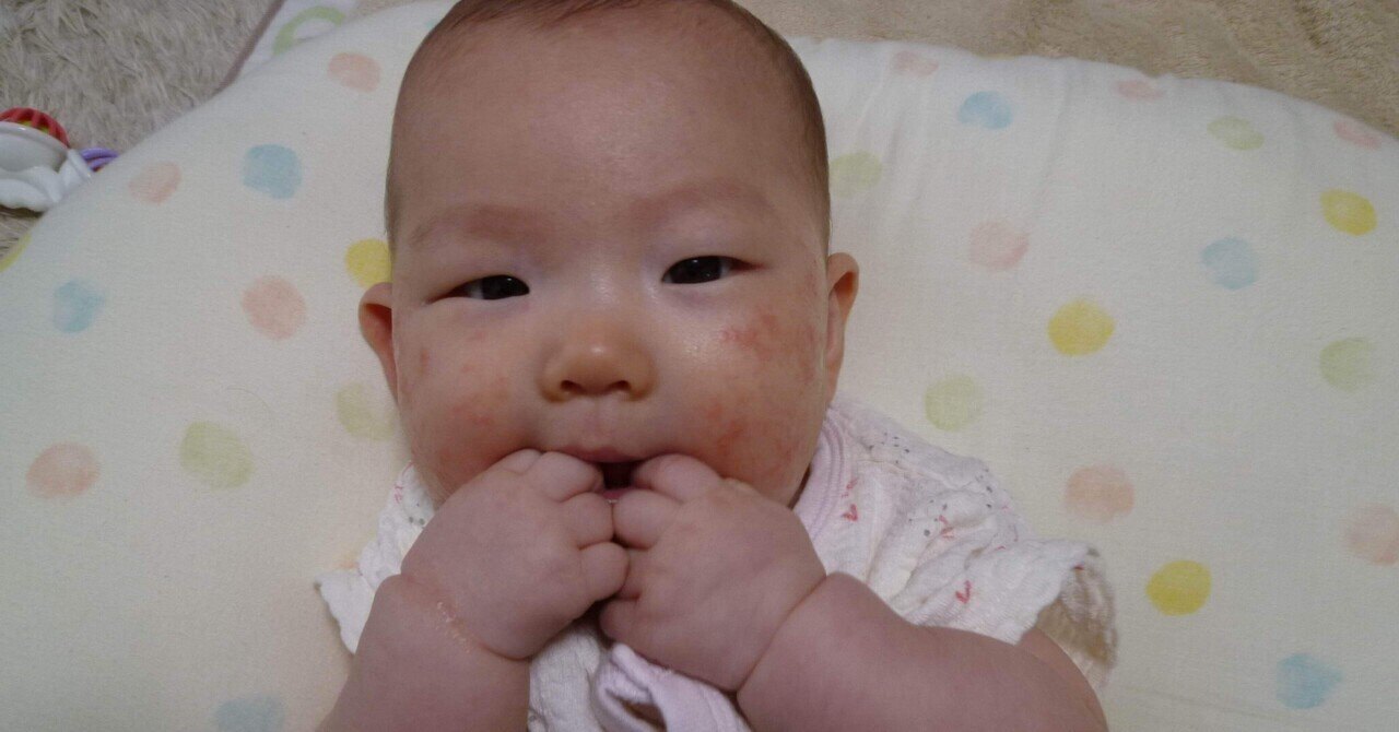 生後5ヶ月、まさかのアトピー診断｜kasaneni_shima
