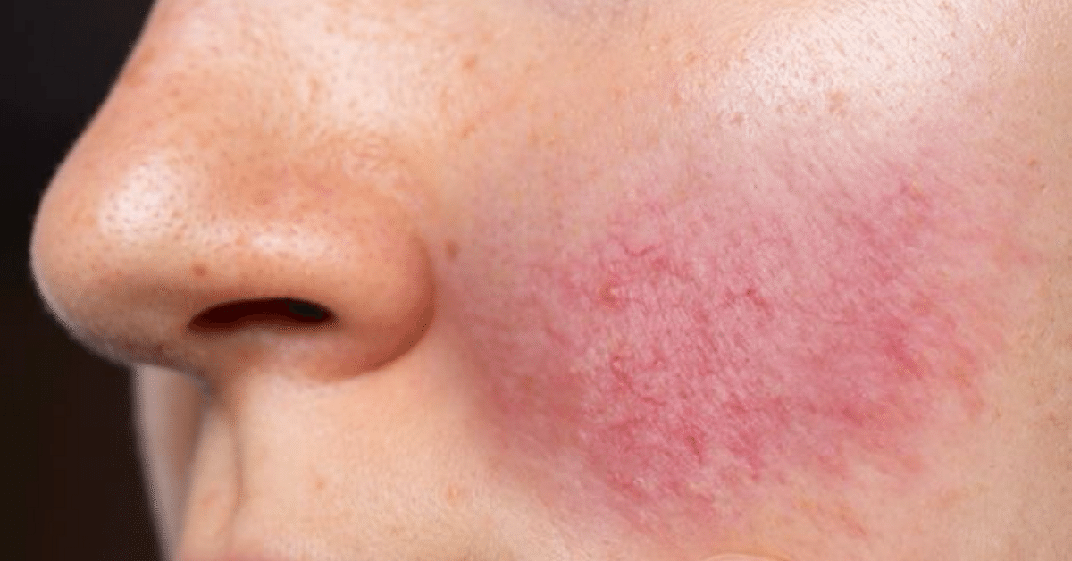 寒暖差と肌荒れの関係｜AKANE_HATANO