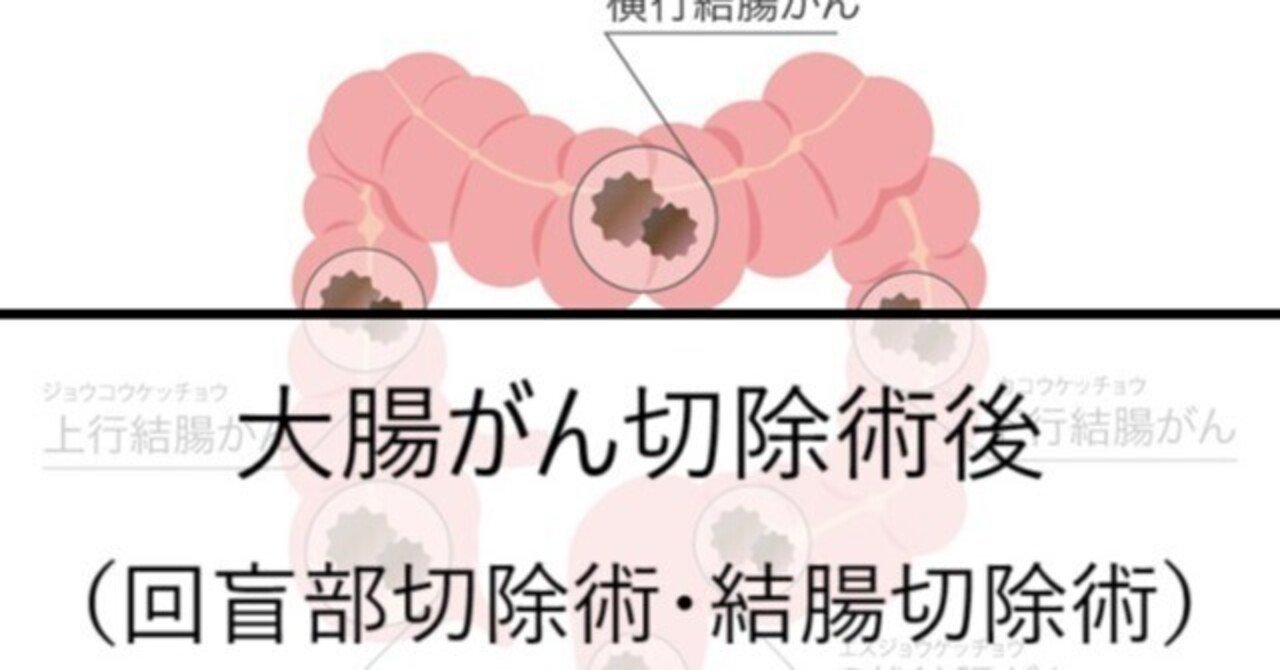 【完全公開はnoteだけ】サクッとまるわかり！大腸がん切除術後（回盲部切除術・結腸切除術）の看護診断｜なんでなんだナーシング30