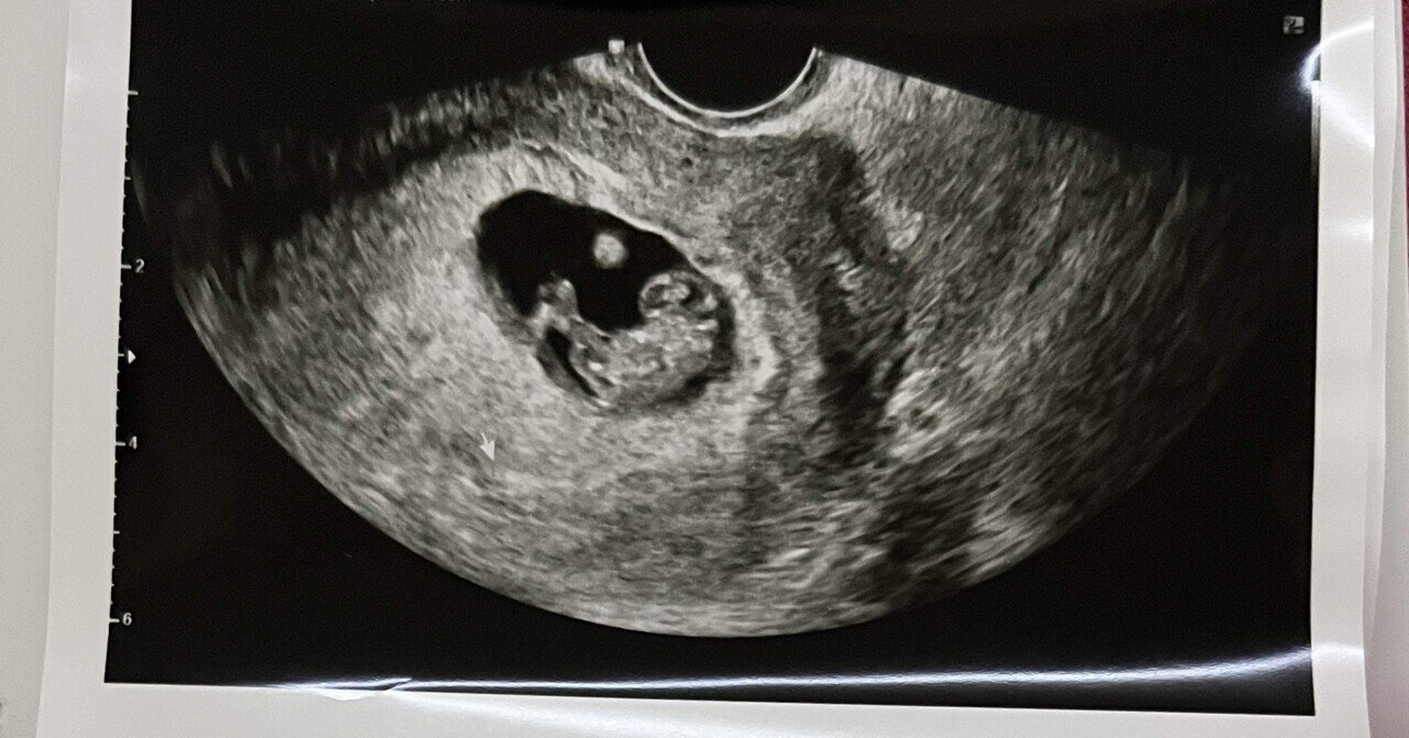 【韓国】妊婦検診2回目8w5d｜RK