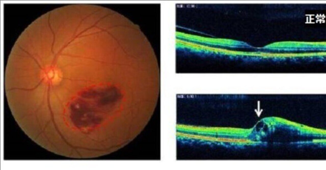 【終活日記】網膜静脈閉塞症｜Hiro／AIに取り組む65歳