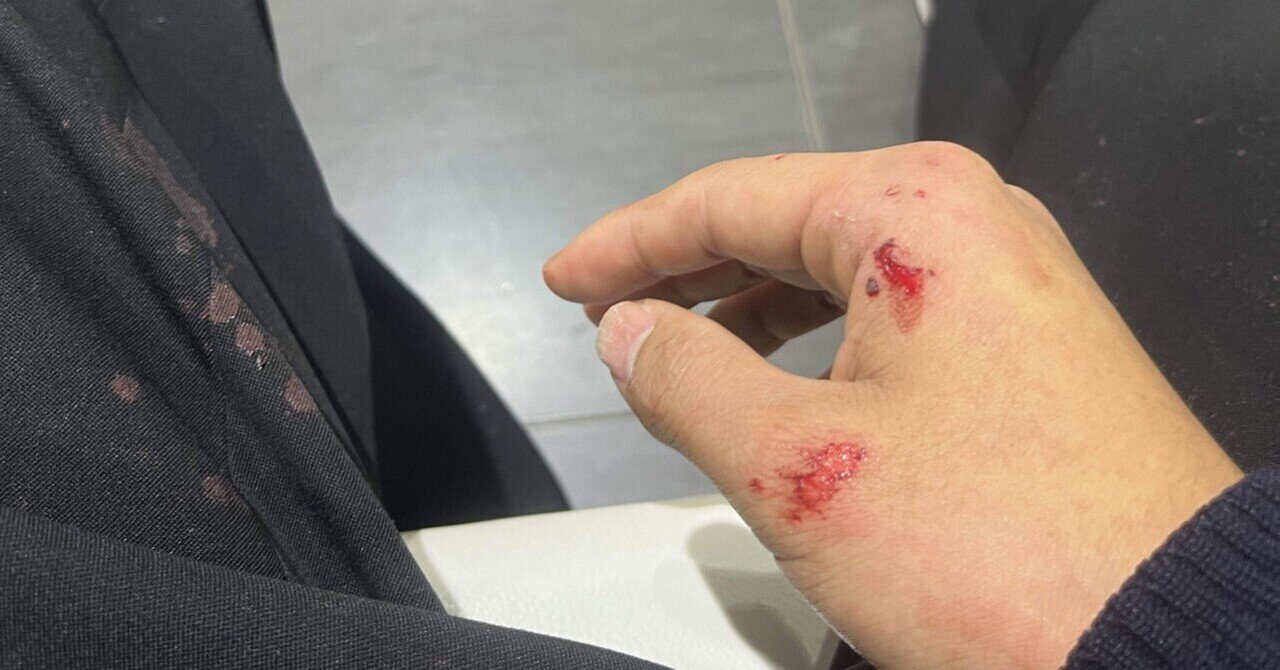 前歯欠損｜Hinato136