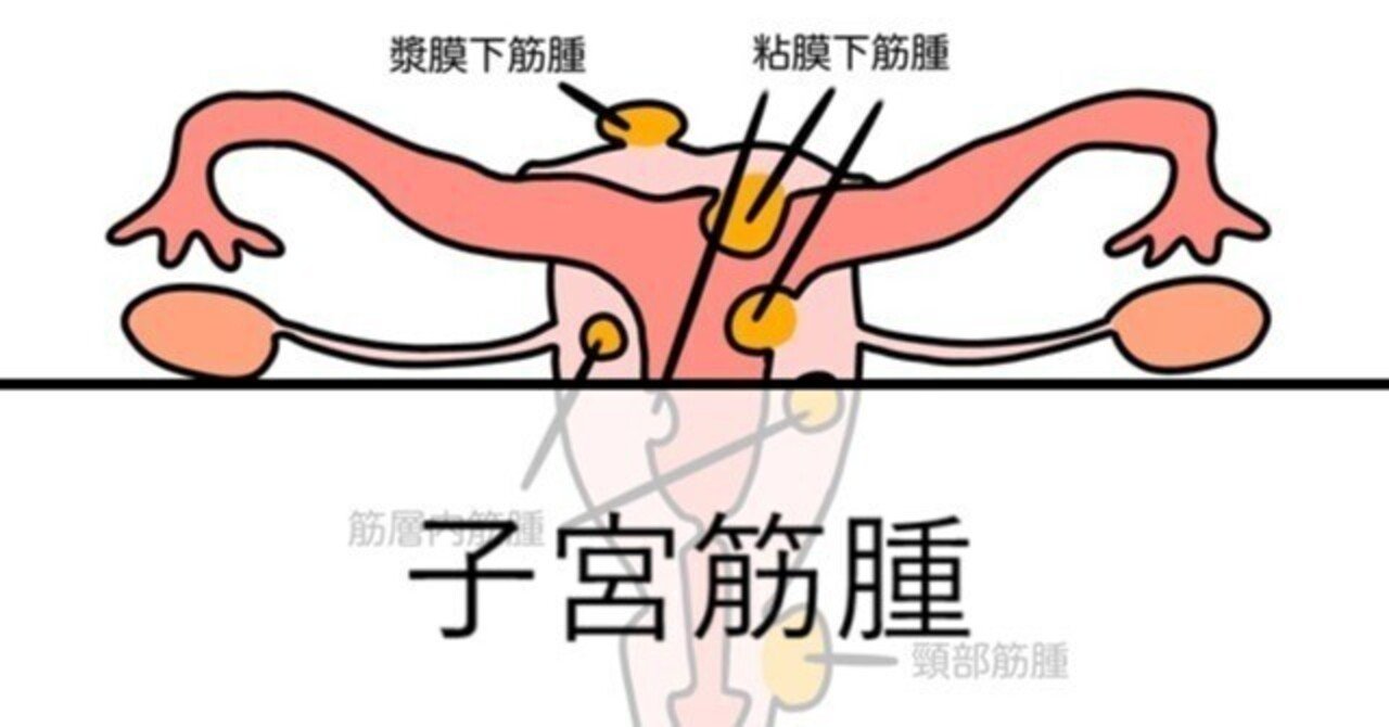 【完全公開はnoteだけ】サクッとまるわかり！子宮筋腫の看護診断｜なんでなんだナーシング30