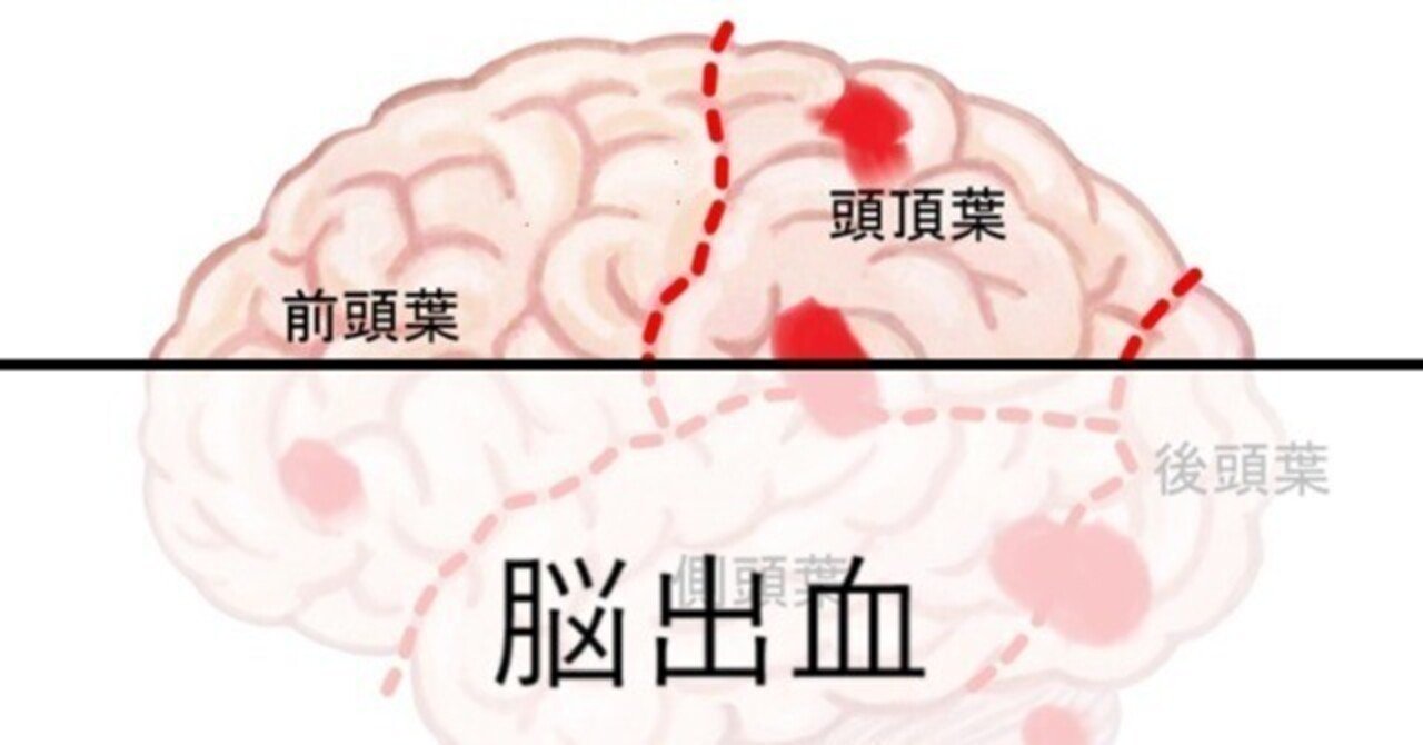 【完全公開はnoteだけ】サクッとまるわかり!脳出血の看護診断|なんでなんだナーシング30