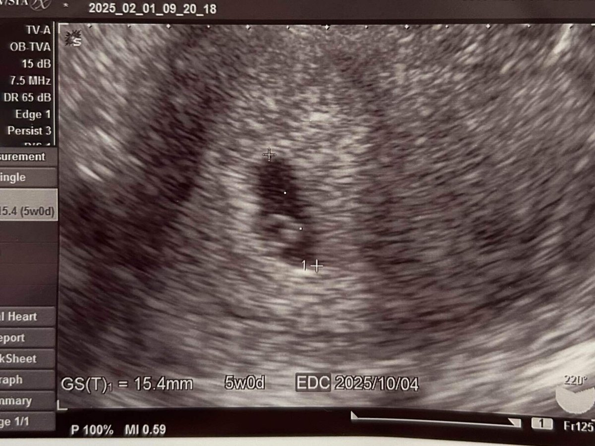 6w4d・心拍確認｜ミナ