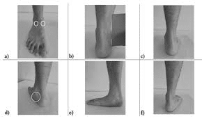 理学療法士のための足部評価ガイド：具体例と実践的アプローチ｜ぐー @リハビリとお金の先生
