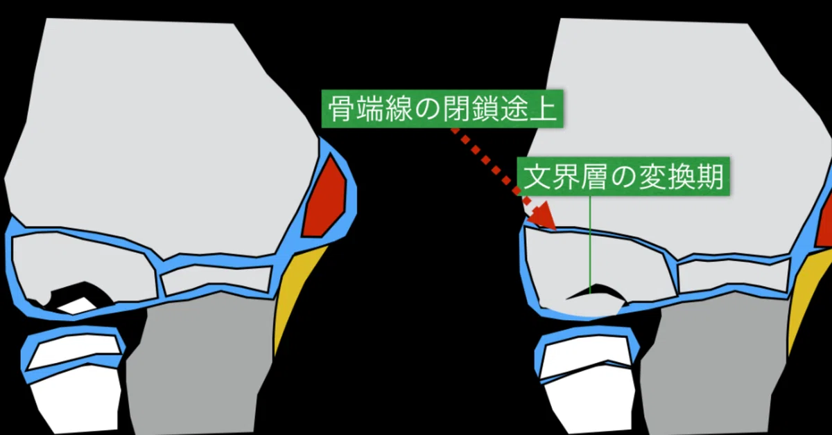 野球少年を襲う病魔〜痛くない野球肘がある？part3〜｜吉田干城 野球長期育成研究家