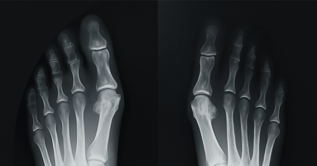 外反母趾を“構造”から治す −裸足・足趾・距骨・骨盤までの再生−｜續池均（kintsuzuike）@MTR Method Lab®︎