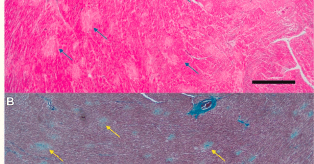 瘢痕：ピアレビューを経た剖検研究は、日本の心臓専門医・小泉智美（Koizumi Tomomi）博士と病理学者・小野正男（Ono Masao）博士が主導し、その成果は《JACC: Case ...