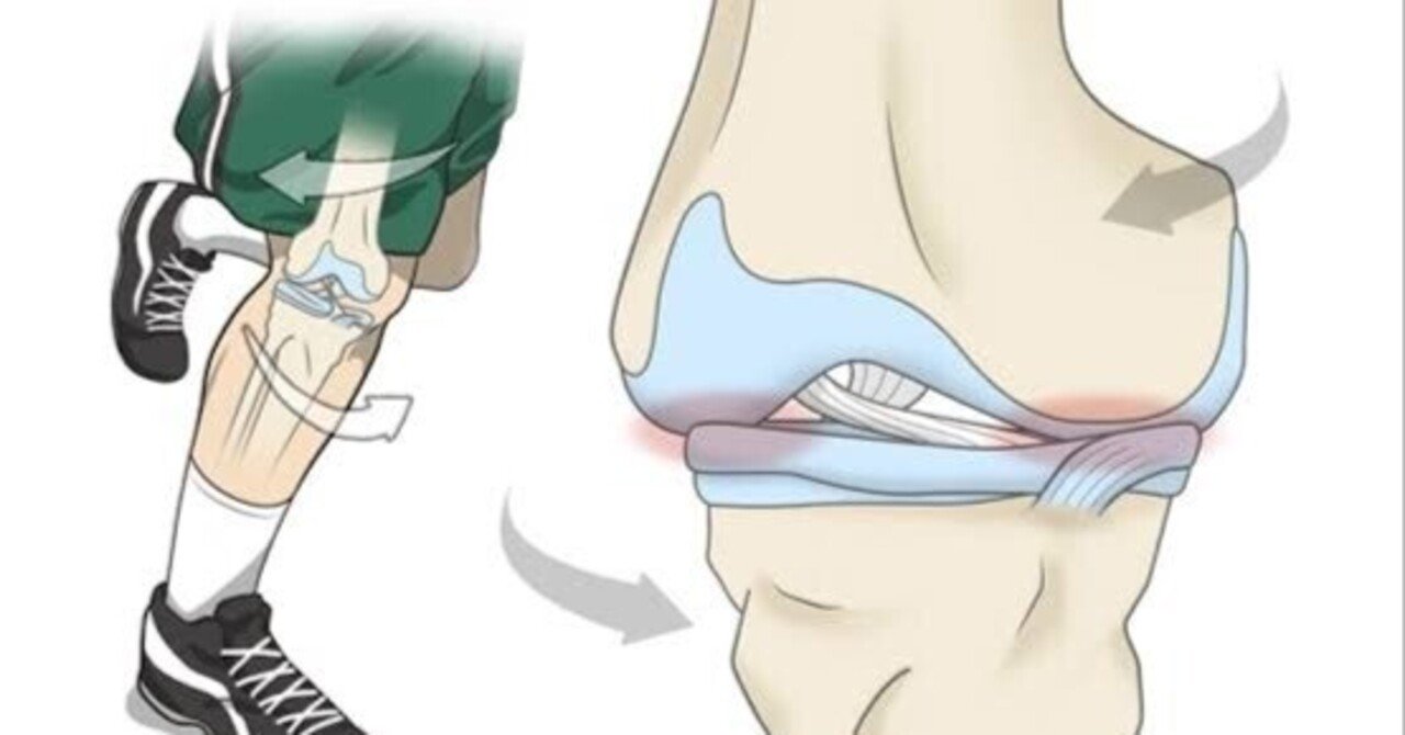 【現場トレーナー必見】半月板部分切除術後のリハビリと競技復帰の流れ｜nakaba_ueno