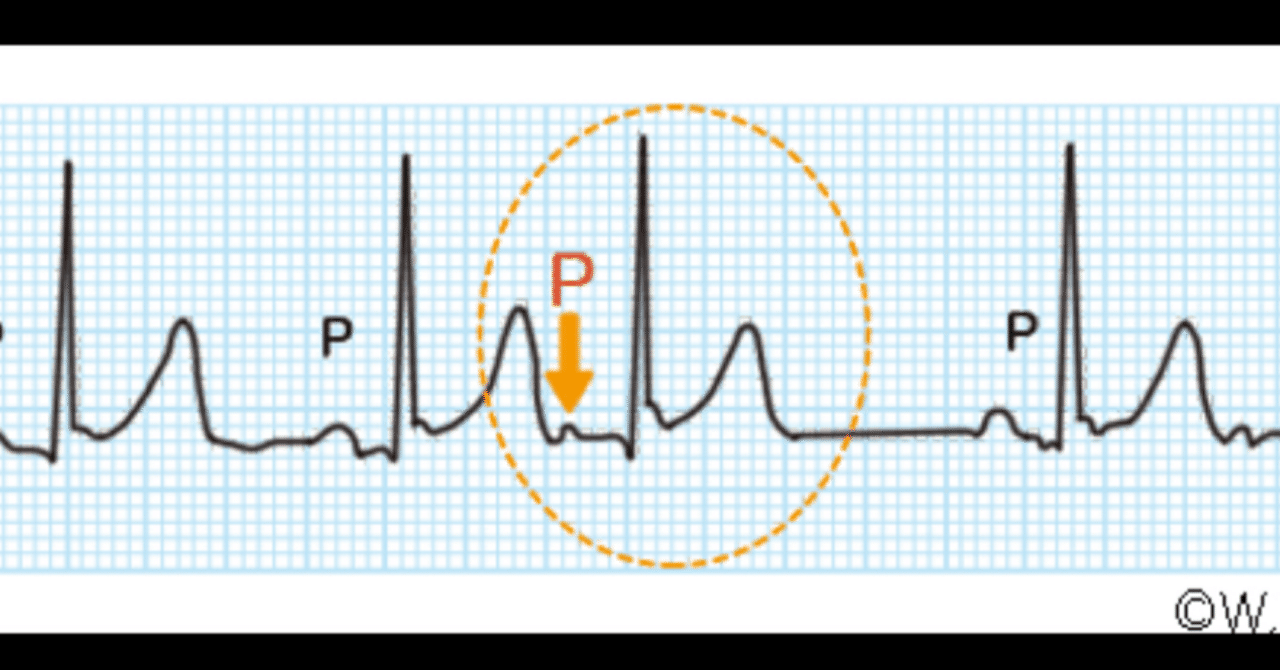 心房性期外収縮（PAC）とblocked PAC―心電図検定に出る「早いP波」の正体を見破れ！―｜すけたろう