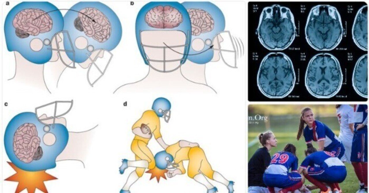 スポーツ脳震盪の新常識！エビデンスが示す“回復の科学”最前線｜Brain storm conditioning 〜 脳からコンディショニング