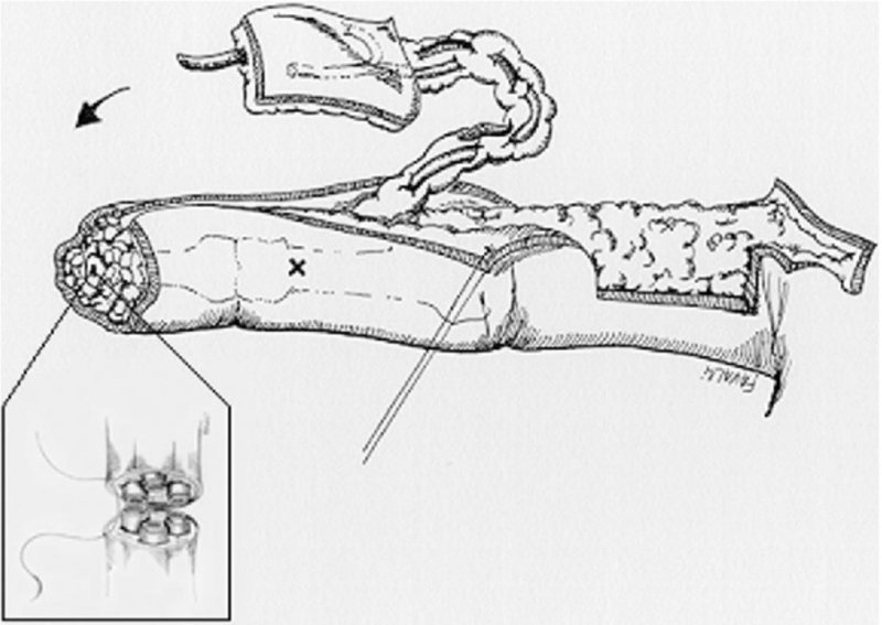 Island flap における Direct Flow Flap と Reverse Flow Flapの比較｜Plastic-Yuki