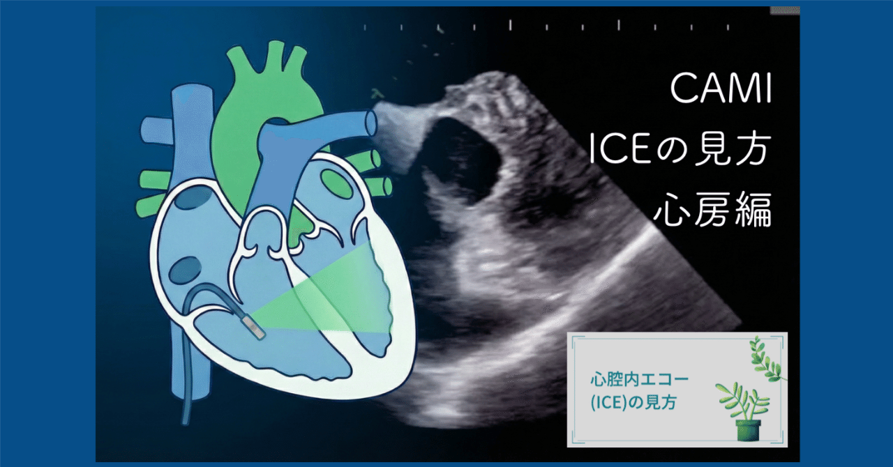 【動画解説】心腔内エコー（ICE）操作の基本とコツ 〜SOUNDSTARとCARTO3の連携〜 心房編｜Comprehensive ...