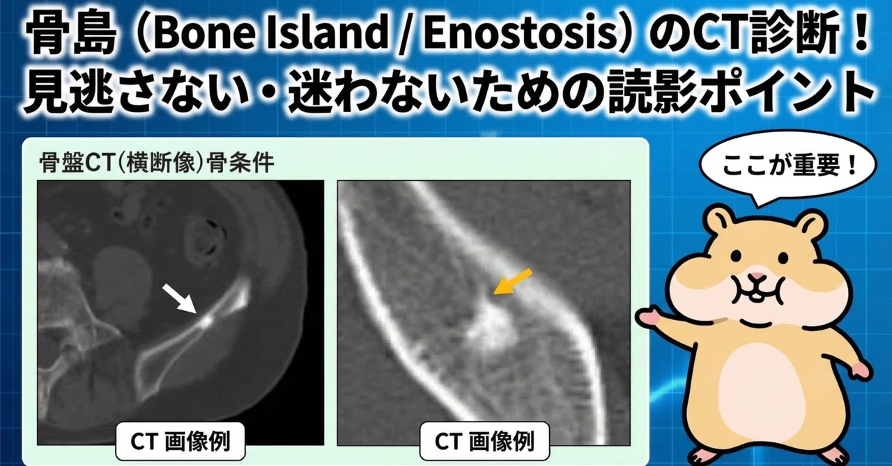 骨島（Bone Island / Enostosis）のCT診断！見逃さない・迷わないための読影ポイント ｜とっとこ画像診断太郎