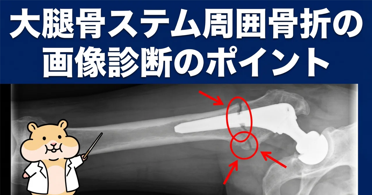 Key Points in Diagnostic Imaging of Periprosthetic Femoral Fractures ...