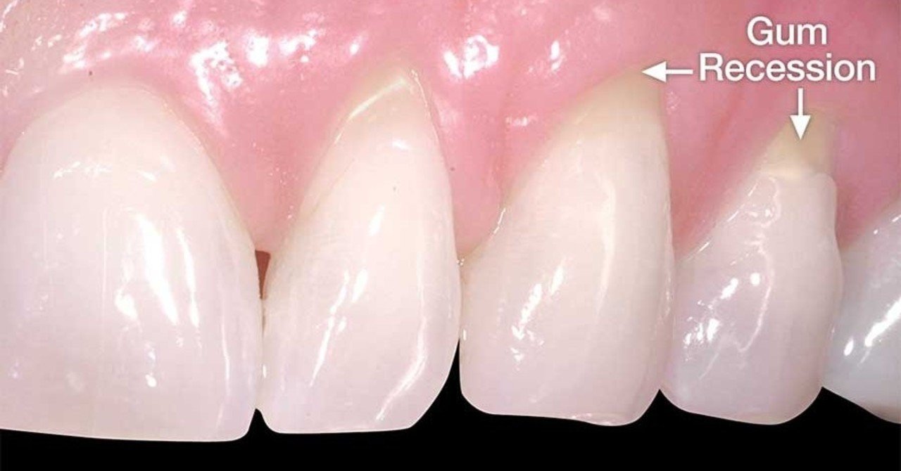 Stop Receding Gums At Home｜Joseph Coleman
