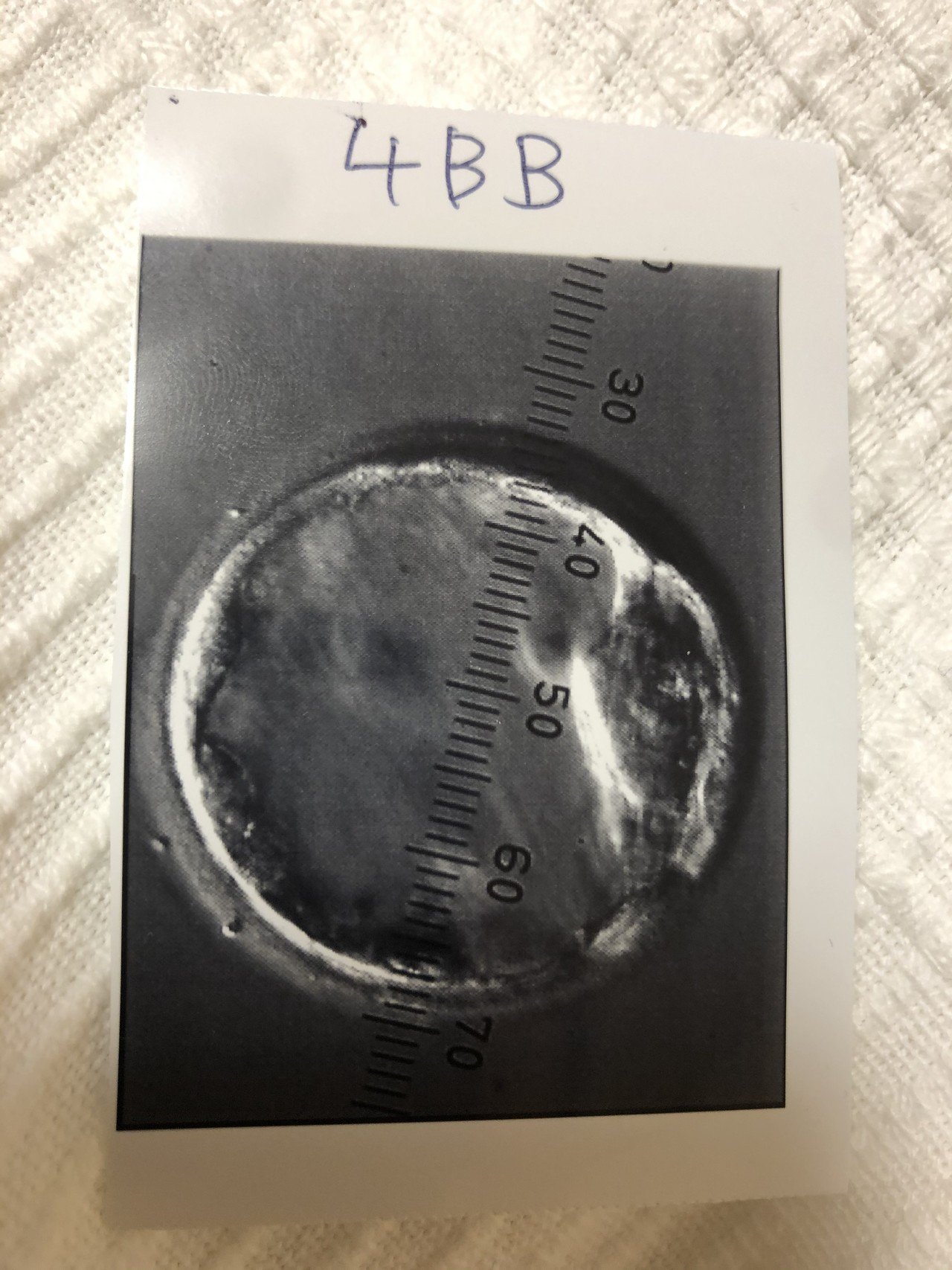 4BBの胚盤胞｜ゆい｜note