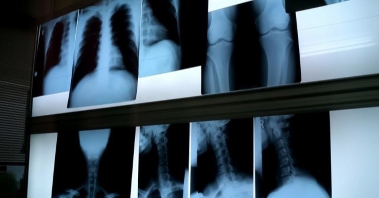 アトピー治療のステロイド注射と骨密度｜ライジン＠アトピーでも快適に生きる道｜note