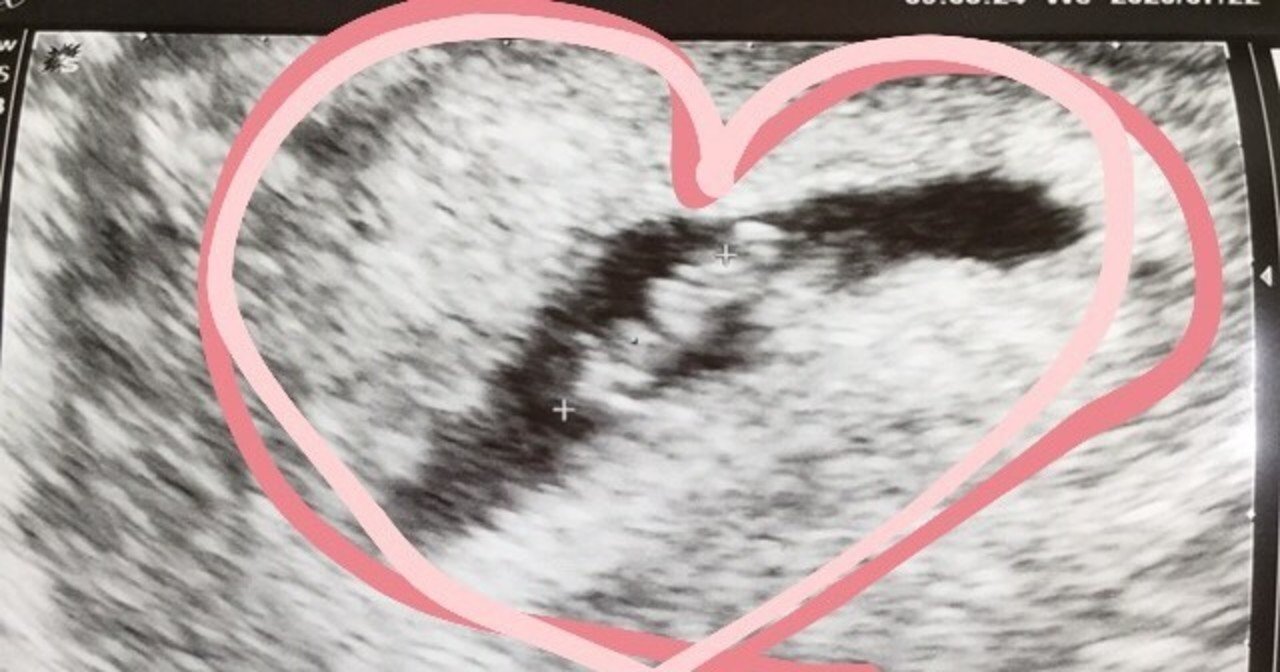 7w1d。ET34klc心拍確認｜にこ天使ママ