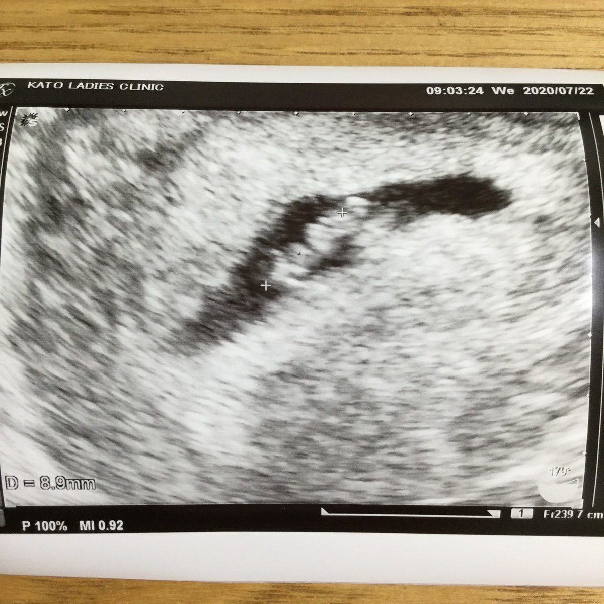 7w1d。ET34klc心拍確認｜にこ天使ママ