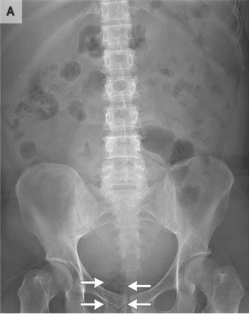 Emphysematous Prostatitis｜佐藤 嵐士