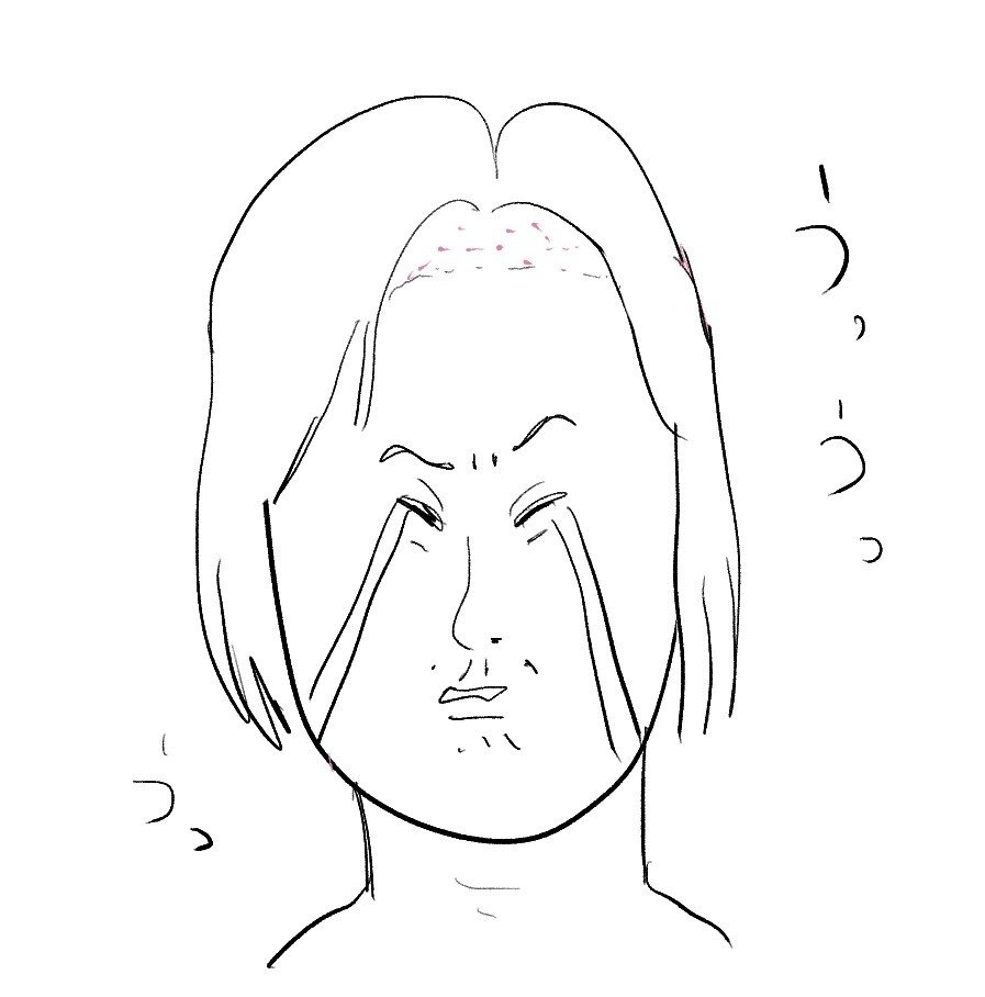 コスパが良かった施術、それは「おでこ」脱毛〜その2〜｜🍰