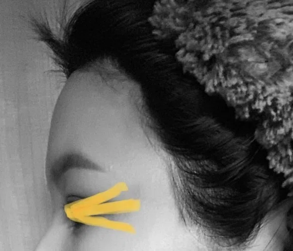 コスパが良かった施術、それは「おでこ」脱毛〜その2〜｜🍰