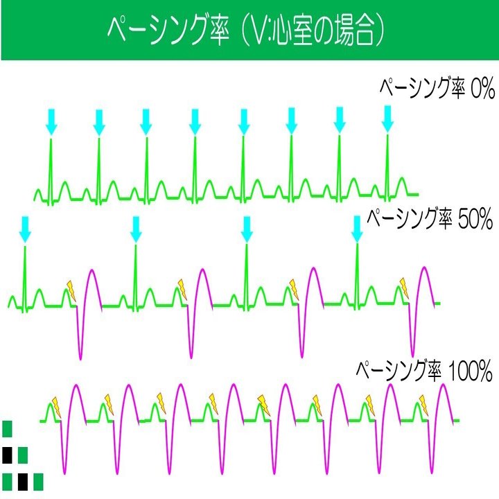 ペーシング率とは｜ペースメーカをゆるりとひもとく｜note