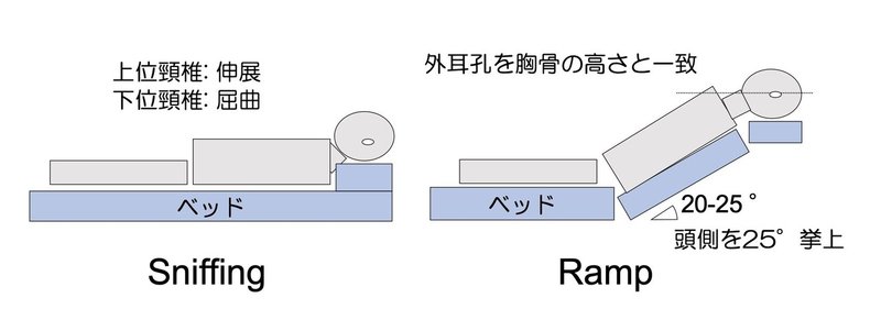 気管挿管の体位、Ramp vs Sniffing｜岡田遥平 | Yohei Okada（救急医）