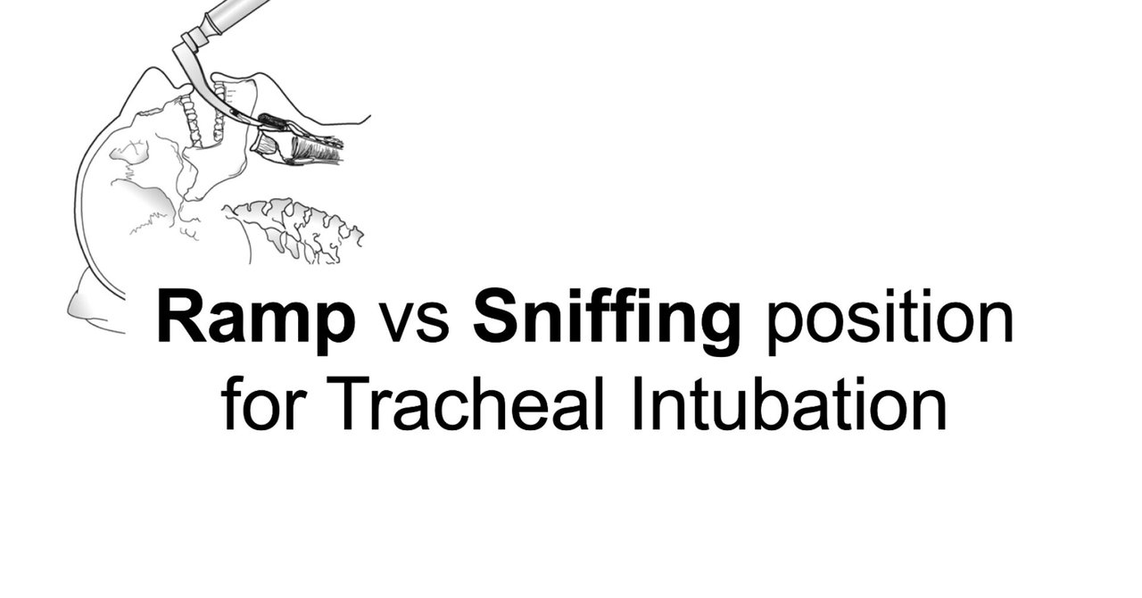 気管挿管の体位、Ramp vs Sniffing｜岡田遥平 | Yohei Okada（救急医）
