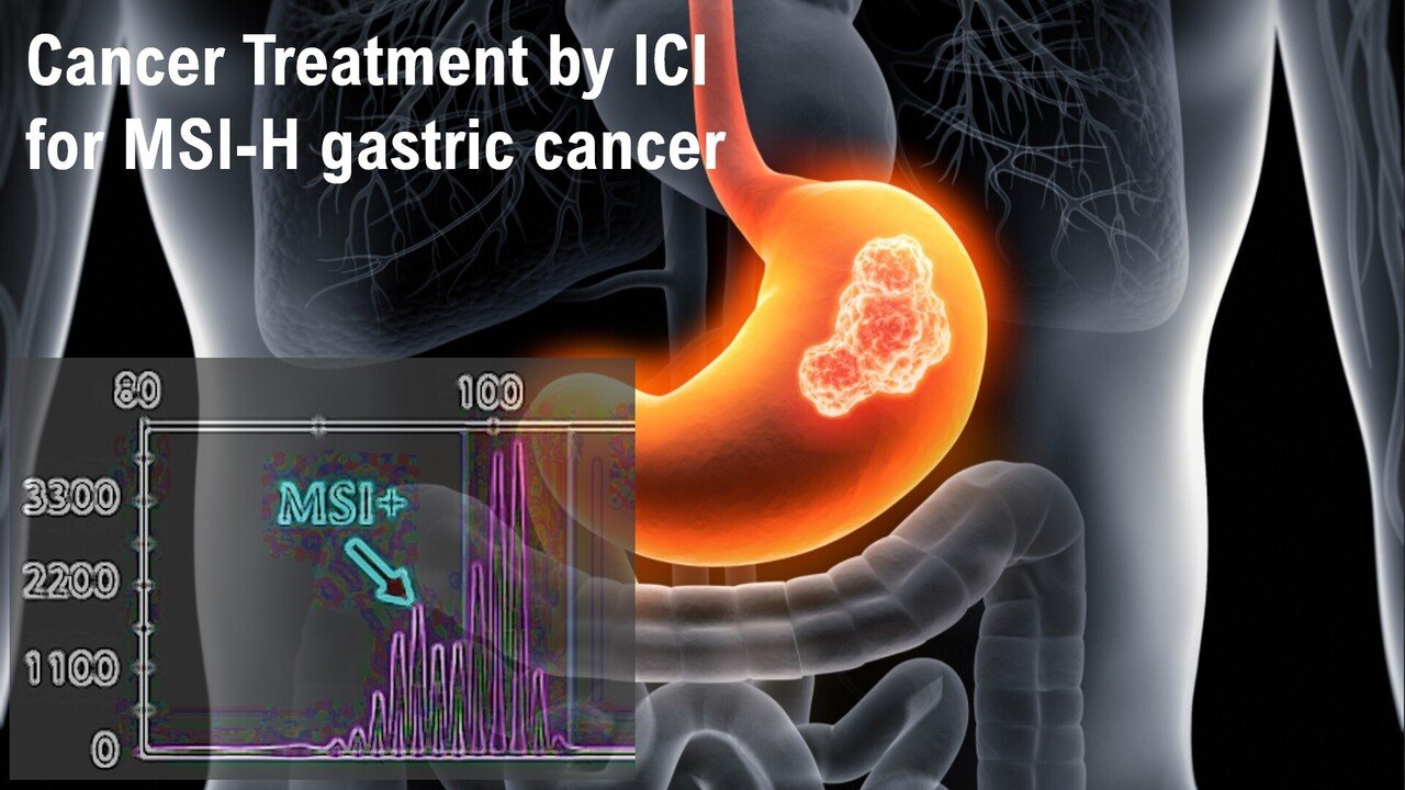 Low prevalence of MSI-High cancer in Japanese patients｜Takuma H｜note