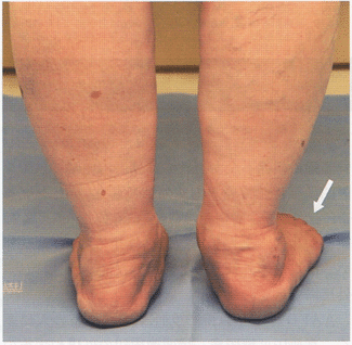 足関節背屈制限を診る上で必要な知識⑤神経、扁平足、外反母趾｜小林 博樹